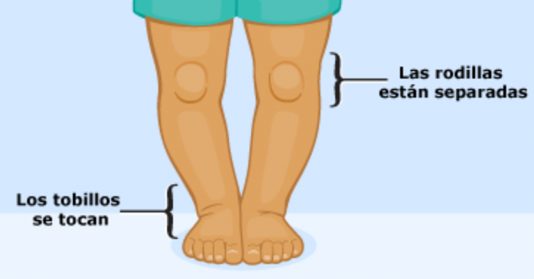 Genu Varo. Ortopedia Infantil. Tairon Diaz